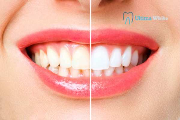 The Best Way 2 Achieve Whiter Teeth Southall Book NOW